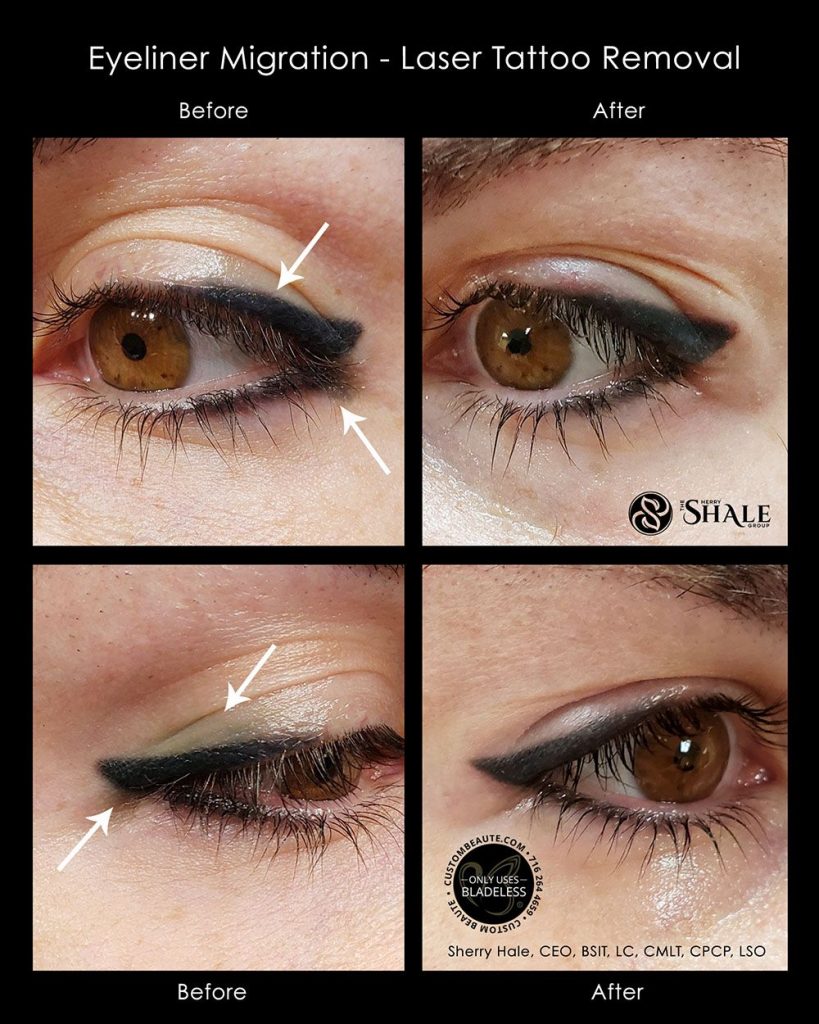 Laser Eyeliner Tattoo Removal in Amherst, Buffalo, Western NY